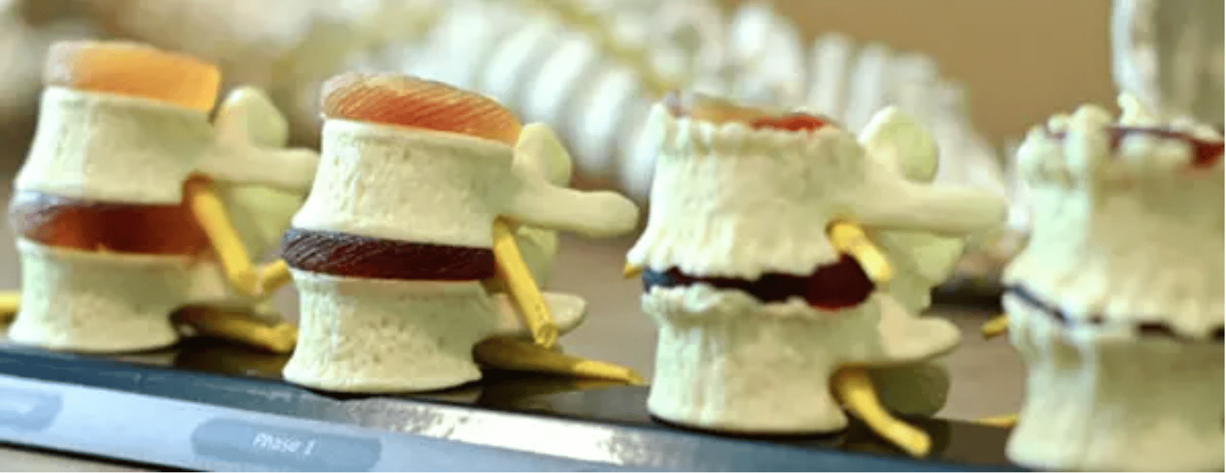 Chiropractic Care and Your Herniated Disc Pain - MyoCore